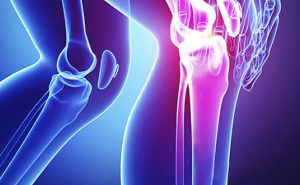 Conozca qué es la Meniscopatía de rodillas y como afecta la marcha ...